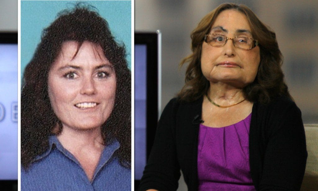 Morta Connie, prima donna a ricevere trapianto di faccia dopo che il ...
