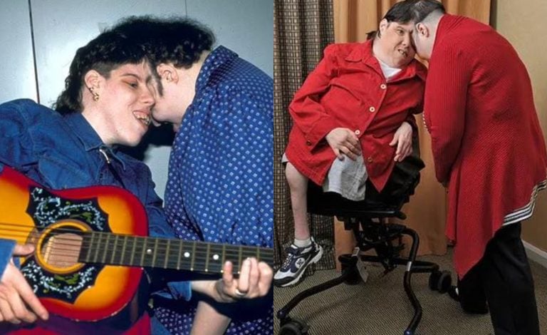 Morti a 62 anni i gemelli siamesi Lori e George Schappell: erano i più ...