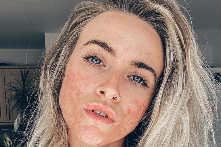 Le Influencer Sui Social Non Nascondono Più Lacne Jess Mackenzie E Le