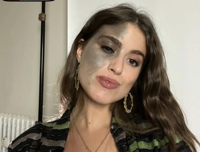 Carlotta Bertotti: "Sul viso il Nevo di Ota, un insieme di lentiggini ...
