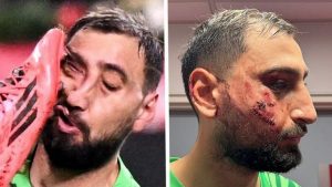Cosa è successo a Donnarumma in faccia, perché ha una cicatrice che ...