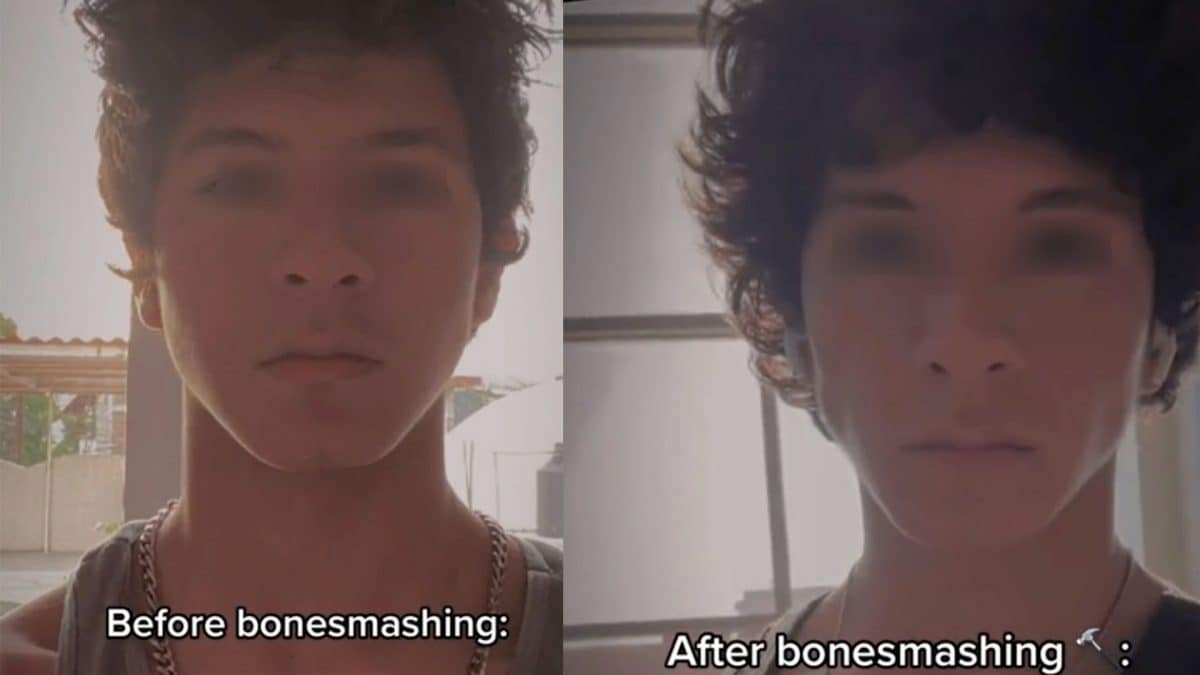 Bone smashing, colpirsi il viso per modellare le ossa: i rischi del ...