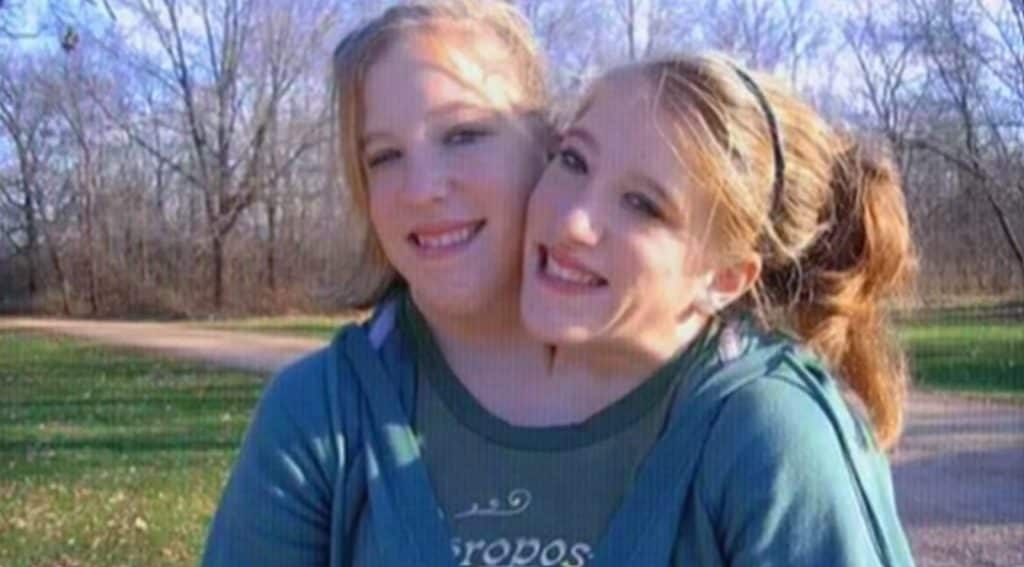 Cosa sono i gemelli siamesi parapagi dicefali: il caso di Abby e Britty
