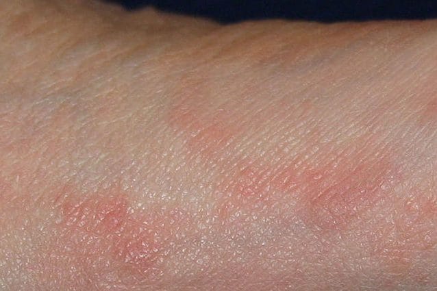 Scabbia, cos'è la malattia che provoca prurito intenso e colpisce ...