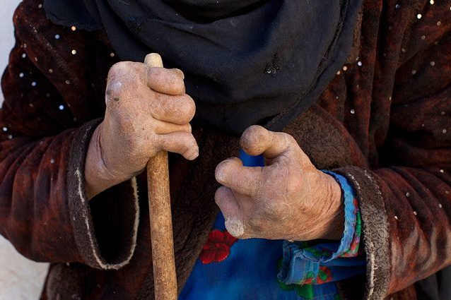 Lebbra: cos'è, quali sono i sintomi e come si cura questa antichissima ...